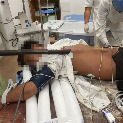 男子高空坠落，身体被钢筋贯穿！中医院医护团队力挽狂澜，携手拯救生命！ 珠海医院患者利器抢救