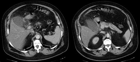 Abdominal Ct Scan Marked Gallbladder Dilatation And Wall Thickening