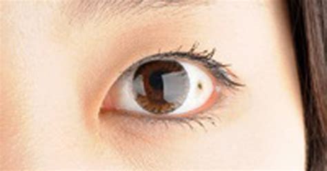 눈에 ‘검은 점 있어도 시력 괜찮을까