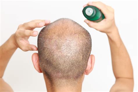 Top 5 Natural Hair Loss Treatment For Men My Simple Remedies