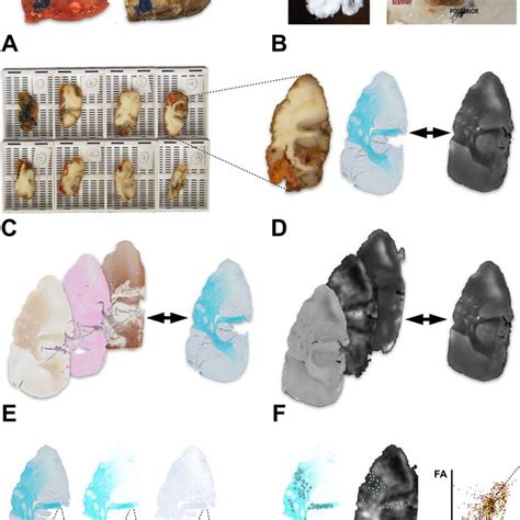 Preoperative Imaging And Orientation Of Resection Specimens Resection Download Scientific