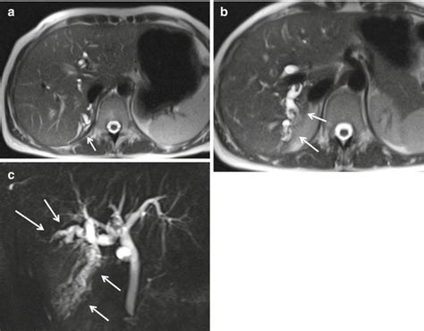 Hepatolithiasis Abdominal Key