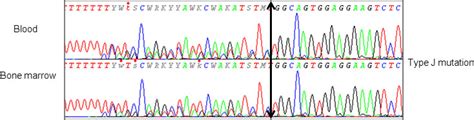 Electropherogram As Generated By Sanger Sequencing Showing Type J Npm1 Download Scientific