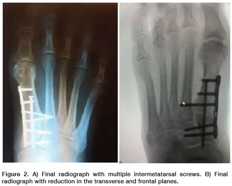 Implementing An Intermetatarsal Screw During Lapidus Arthrodesis