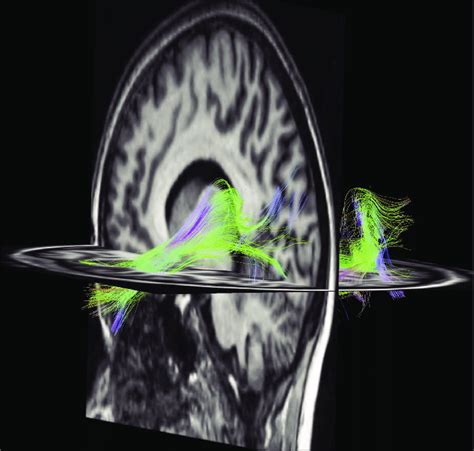 The Uncinate Fasciculus As Viewed In The Sagittal Plane Figure 3 The