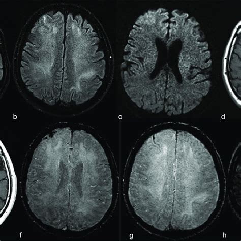 Contrast Enhanced Cranial 1 5T MRI Examination Of A 59 Year Old