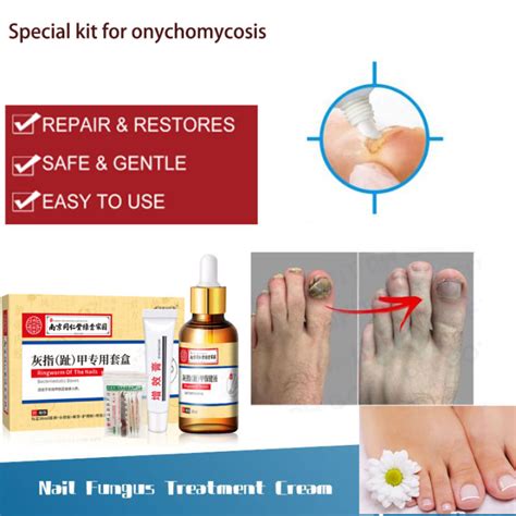Nail Fungusnail Repair Treatment Creamfungal Nail Creamremove