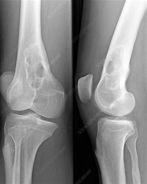 Lytic Lesion In Femur X Ray Stock Image C0436013 Science Photo Library