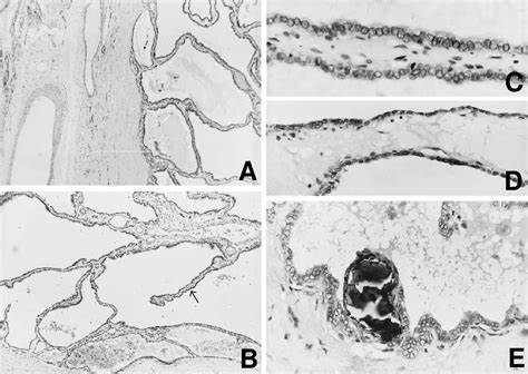 Thyroid Gland Macrofollicular Adenoma Semantic Scholar