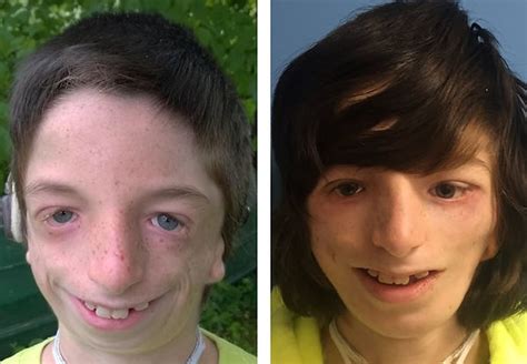 Treacher Collins Syndrome Cleft And Craniofacial Center Utah