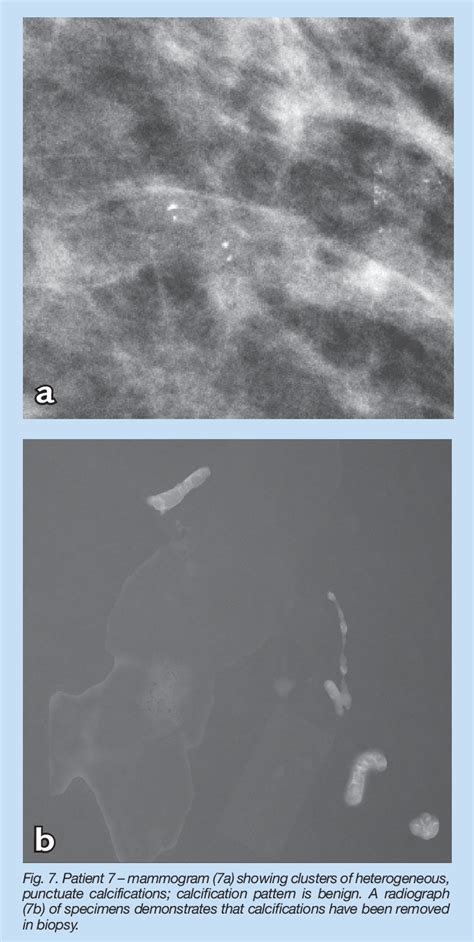 Figure 1 From Histo Pathological Correlation Of Bi Rads 4 Lesions On Mammography With Emphasis