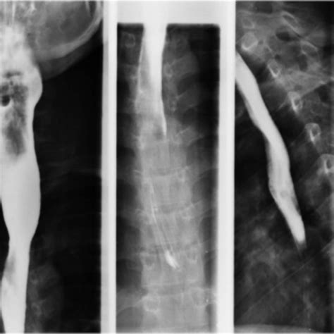 Gastrografin Esophagogram Showing Patency And Integrity Of The