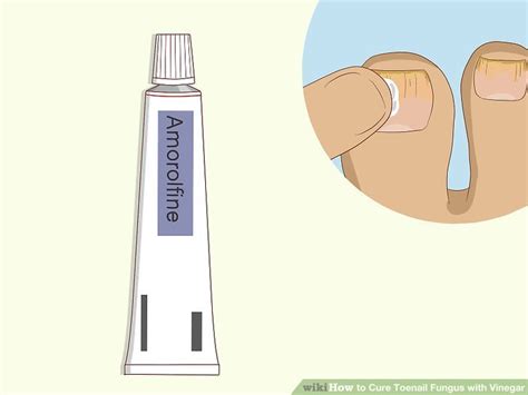 How To Cure Toenail Fungus Can Vinegar Help