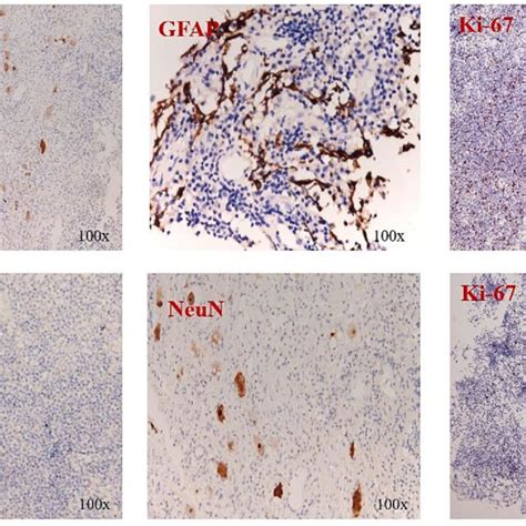 Immunohistochemical Staining Showed The Syn − Ck − Gfap − Neun