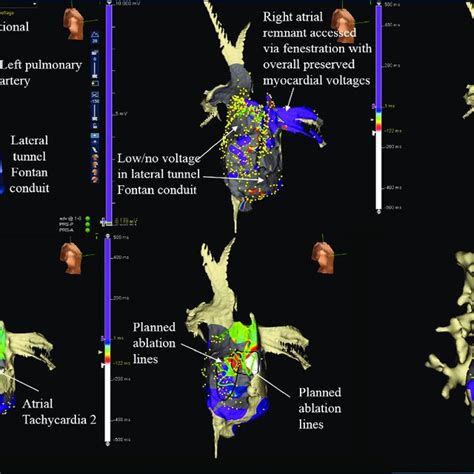 Advanced Cardiac Imaging Integration With Electroanatomic Mapping For Download Scientific