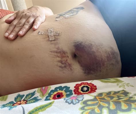 Laparoscopic Bruising Healing Stages R Endometriosis