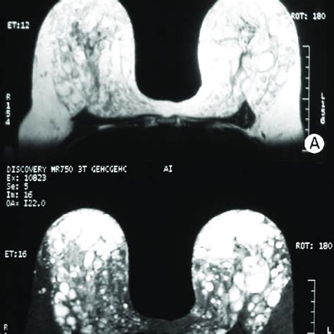 Magnetic Resonance Imaging Image It Showed Diffuse Multiple Nodules In