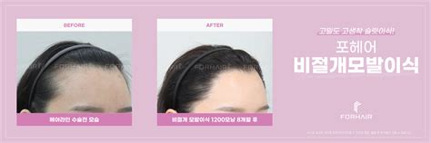 포헤어 모발이식 [ 포헤어 비절개모발이식] 헤어라인 비절개 모발이식 진행 1200모낭 이식 후