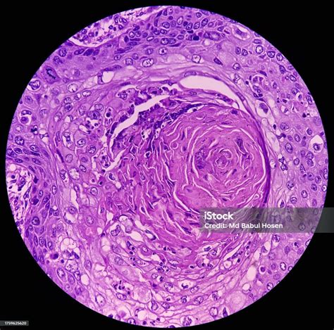 Tissue From Axilla Invasive Squamous Cell Carcinoma Smear Show Skin