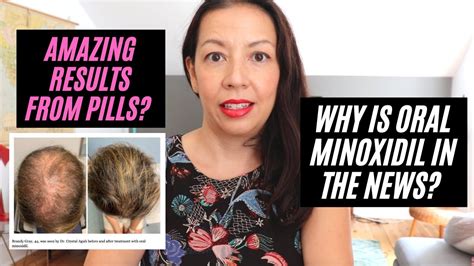 Oral Minoxidil Pills For Hair Loss In The New York Times Has Everyone