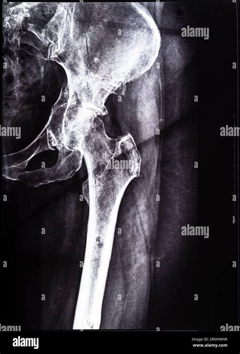Negative X Ray Of Junction Of Tibia And Pelvis After Healed Of Fracture