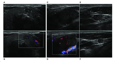 Thyroid And Neck Ultrasound An Irregular Hypoechoic Nodule 11 × 7