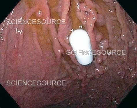 Gastric Polyps And Endoscopy Camera Ca Stock Image Science Source