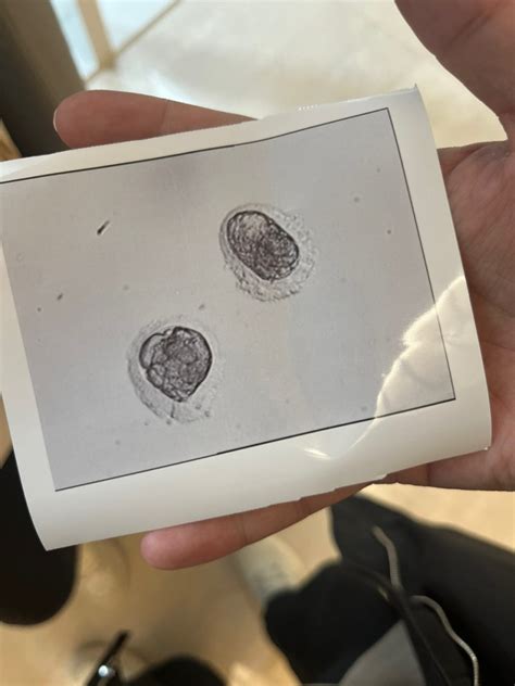 난임일기 Ep6 시험관 1차 준비 3일배양 신선이식 너무 힘들었던 이식 과정과 10일 후 피검사결과 네이버 블로그