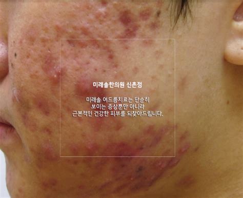 결절성여드름 혹처럼딱딱해 네이버 블로그