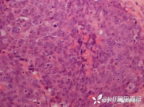 01 21：甲状腺内胸腺癌，隐入未分化 知乎