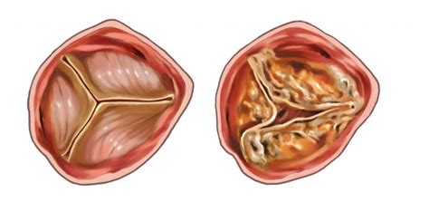 Tricuspid Stenosis Notes Read