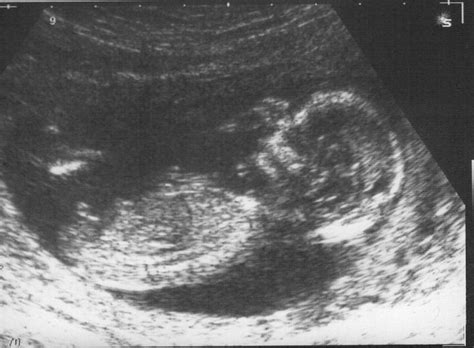 Ecografía De 16 Semanas Varón Imagui