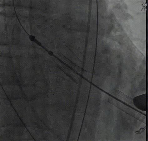 独家瓣法·冠脉遮挡横位心恶性肿瘤同期pci｜西安交大一附院心外科闫炀教授团队应用j Valve完成3例tavr 严道医声网