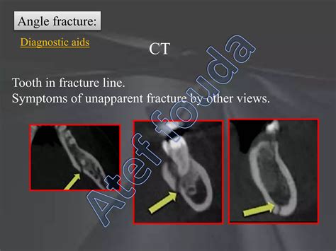 Fracture Mandibular Angle Ppsx