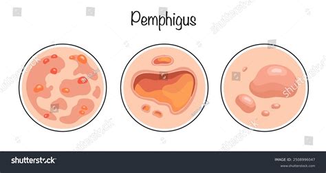 Pemphigus Autoimmune Pathology Skin Mucous Membranes Stock Vector