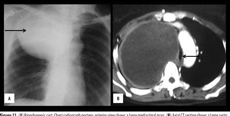 Figure 11 From Imaging Of Retrosternal Space Lesions A Pictorial