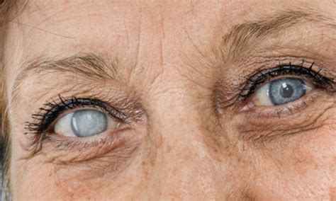 Yag Laser Capsulotomy Before And After Alabata Eye Center
