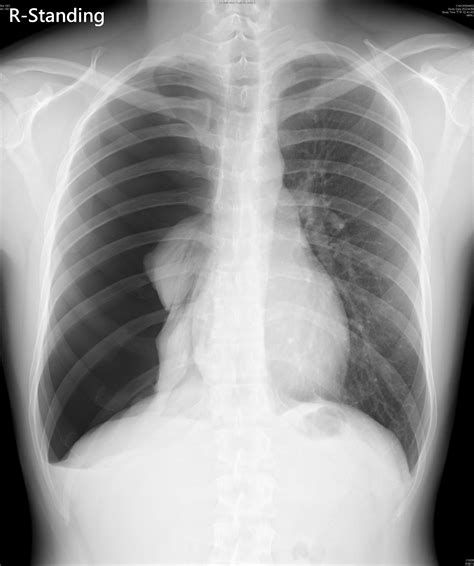 Pneumothorax Model Object Detection Dataset And Pre Trained Model By Rachelwork