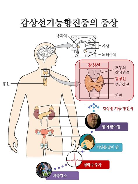 전주 이진복한의원 갑상선기능항진증