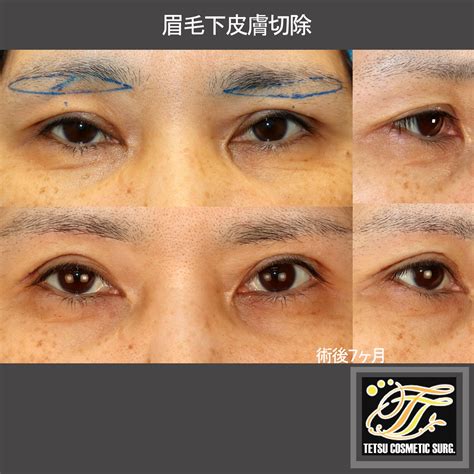 眉毛下皮膚切除 術後7ヶ月 Tetsu形成・美容クリニック 田中哲一郎のブログ