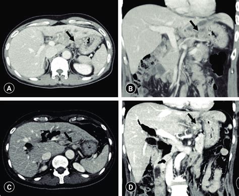 Preoperative Abdominal Computed Tomography Of Patients With Left Sided