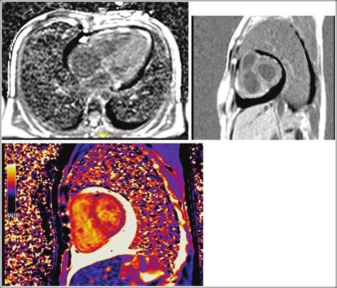 Cardiac Mri Showing Subendocardial Late Gadolinum Enhancement And Download Scientific Diagram