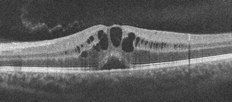 Segmentation Of Oct Rsip Vision
