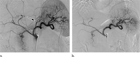 Bariatric Embolization Shows P [image] Eurekalert Science News Releases