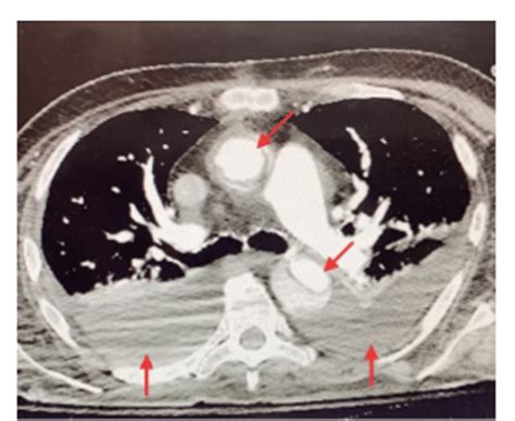 Contrast Enhanced Computed Tomography Scan Showing Cross Sectional