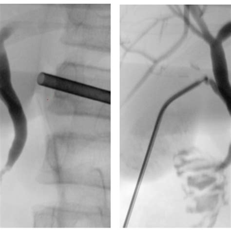 Cholangiography Before And After Flushing Out A Small Stone In The