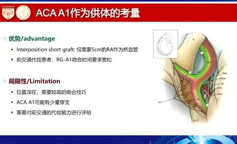 朱巍教授：以大脑前动脉a1为供血支的颅内搭桥术式及其优势 脑医汇