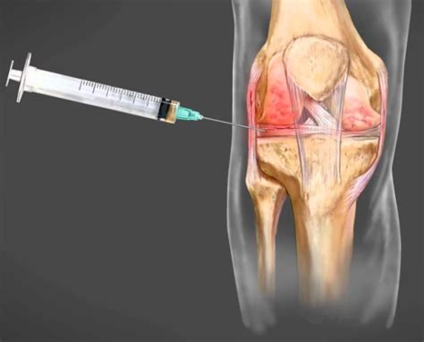 Внутрисуставные уколы с гиалуроновой кислотой для коленного сустава в Минске