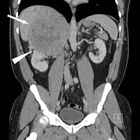 Ct Of Large Right Upper Quadrant Mass Arrowhead Demonstrates Tumor And