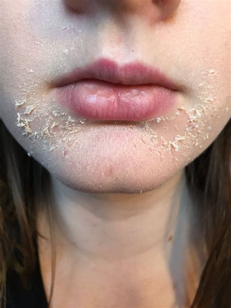 Please Help Me Extremely Dry Flakey Skin From Retin A R